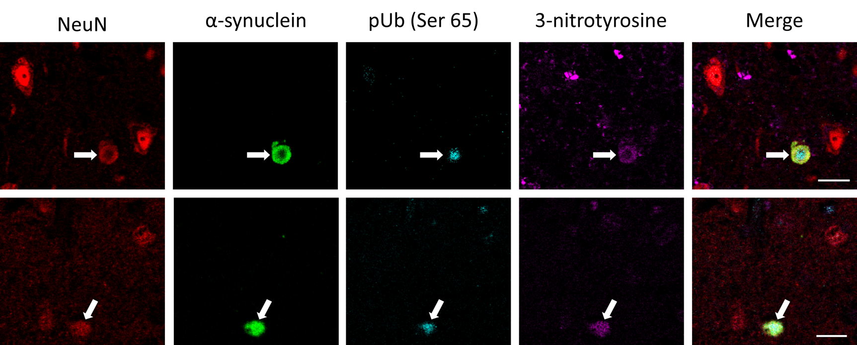The role of Lewy bodies in LBD | Metabolic Neurodegeneration Laboratory ...