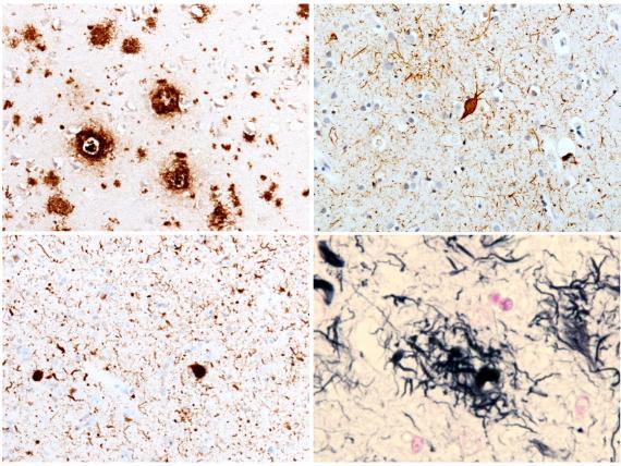 Research; Neurodegenerative Pathology Research Group; Newcastle University